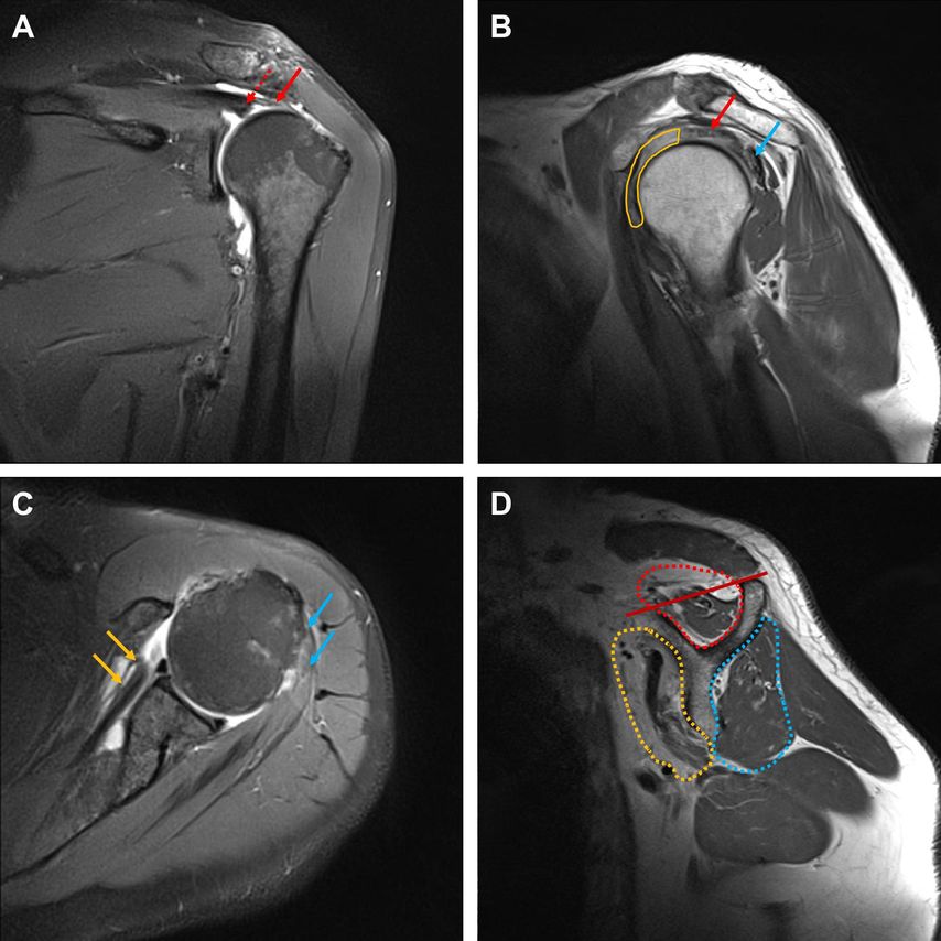 Die delaminierte Rotatorenmanschette - Orthopädie & Traumatologie ...