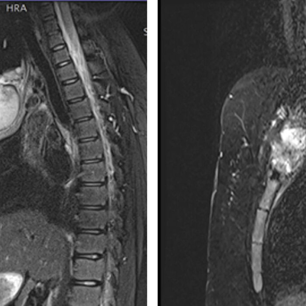 Knochenläsionen zwischen Malignität und Granulomatose - Onkologie ...