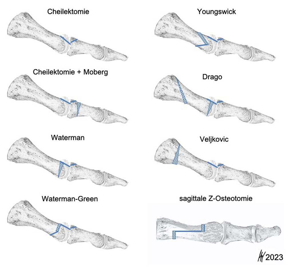 Moderne gelenkerhaltende Eingriffe zur Therapie des Hallux rigidus ...