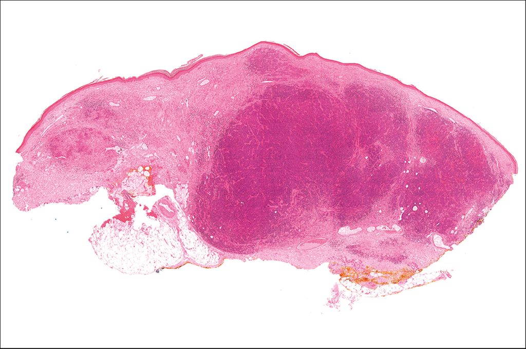 Das Merkelzellkarzinom - Dermatologie - Universimed - Medizin im Fokus