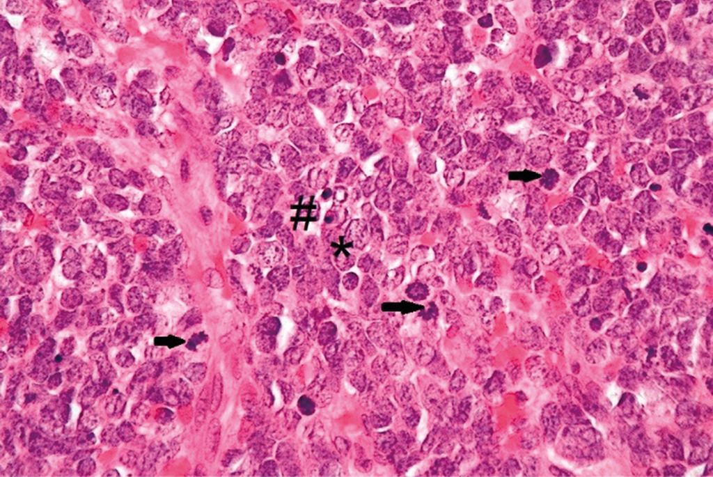 Das Merkelzellkarzinom - Dermatologie - Universimed - Medizin im Fokus
