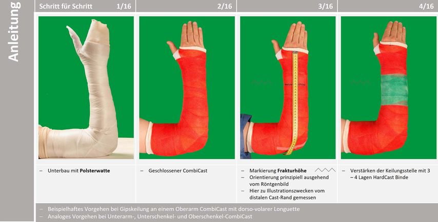 Gipskeilung bei pädiatrischen Frakturen - Orthopädie & Traumatologie ...