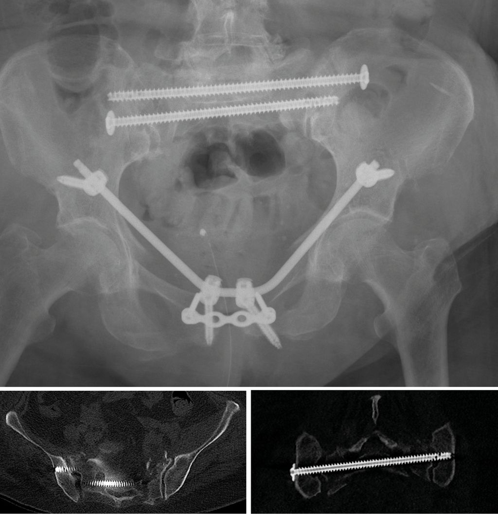 Die Navigation in der Beckenchirurgie mittels LOOP-X - Orthopädie ...