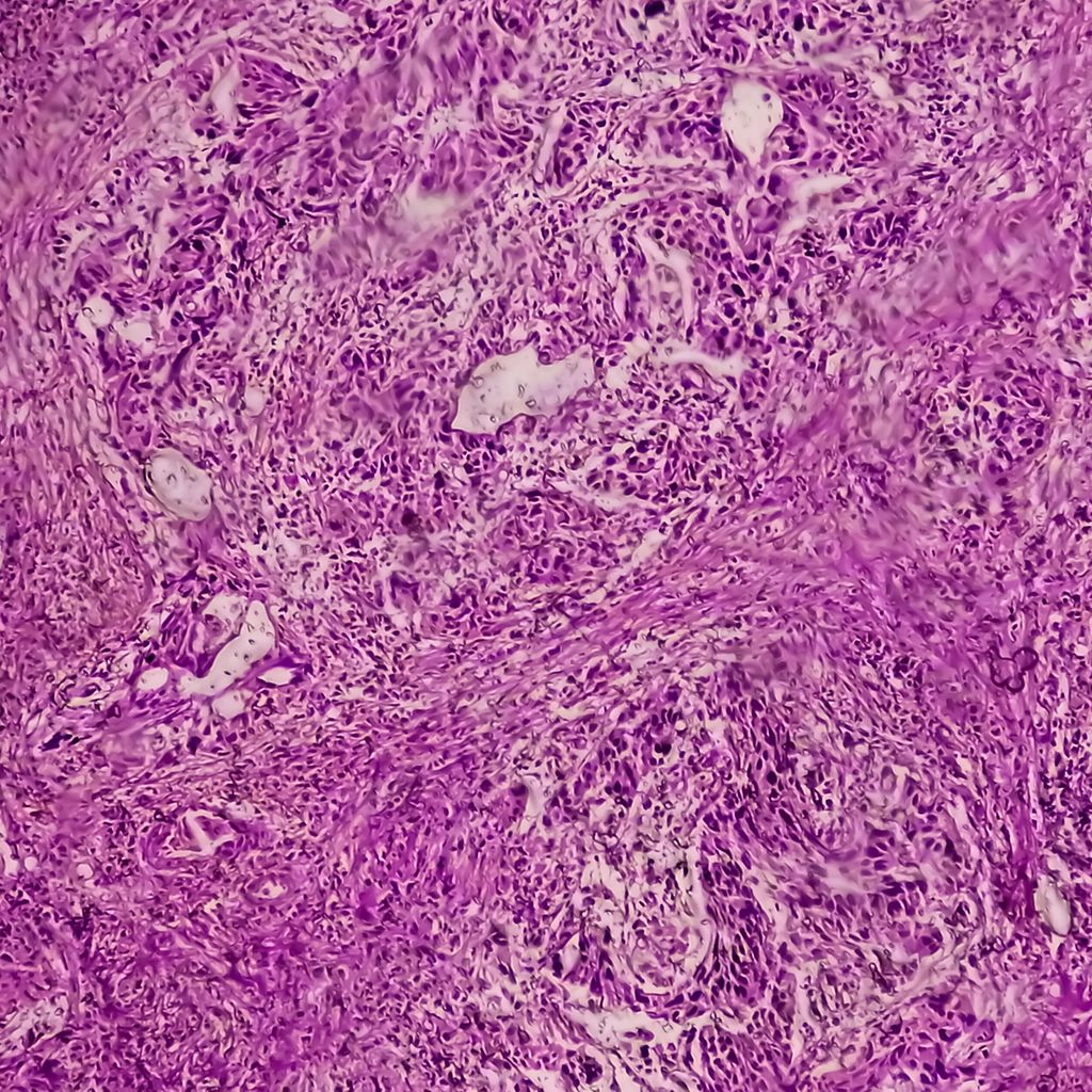 Rückschau: Antikörper-Wirkstoff-Konjugate - Onkologie - Universimed ...