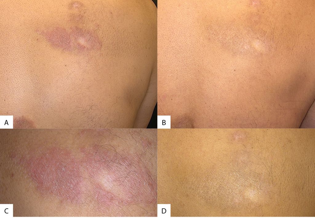 Notalgia paraesthetica: eine dermatologische Herausforderung ...