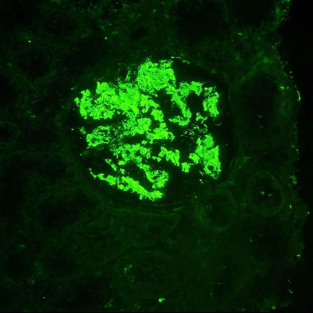 Können Biomarker bei der Diagnose helfen? - Nephrologie - Universimed ...