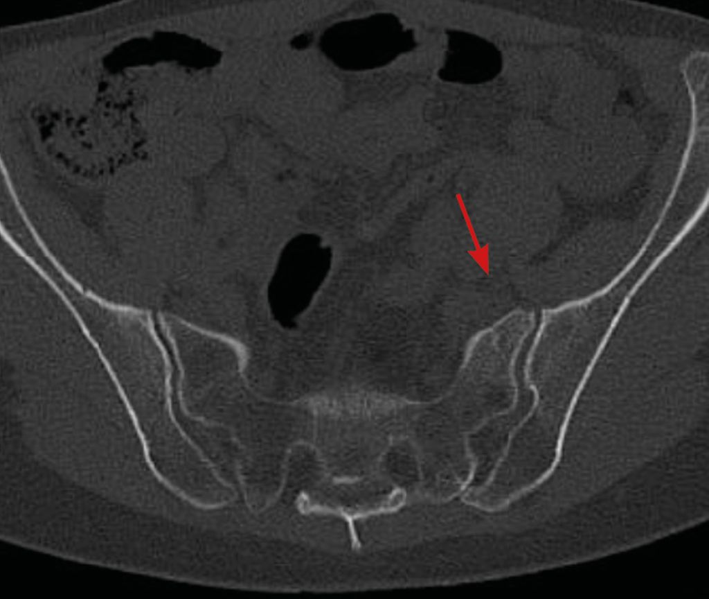 Bildgebung bei Fragilitätsfrakturen - Orthopädie & Traumatologie ...