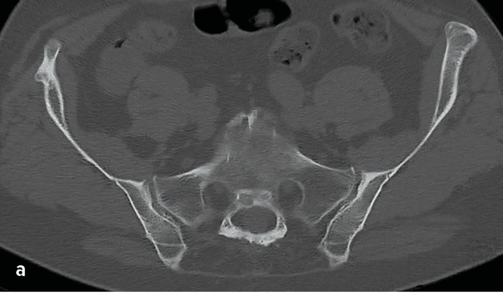 Osteoporoseassoziierte Fragilitätsfrakturen des Beckenrings ...