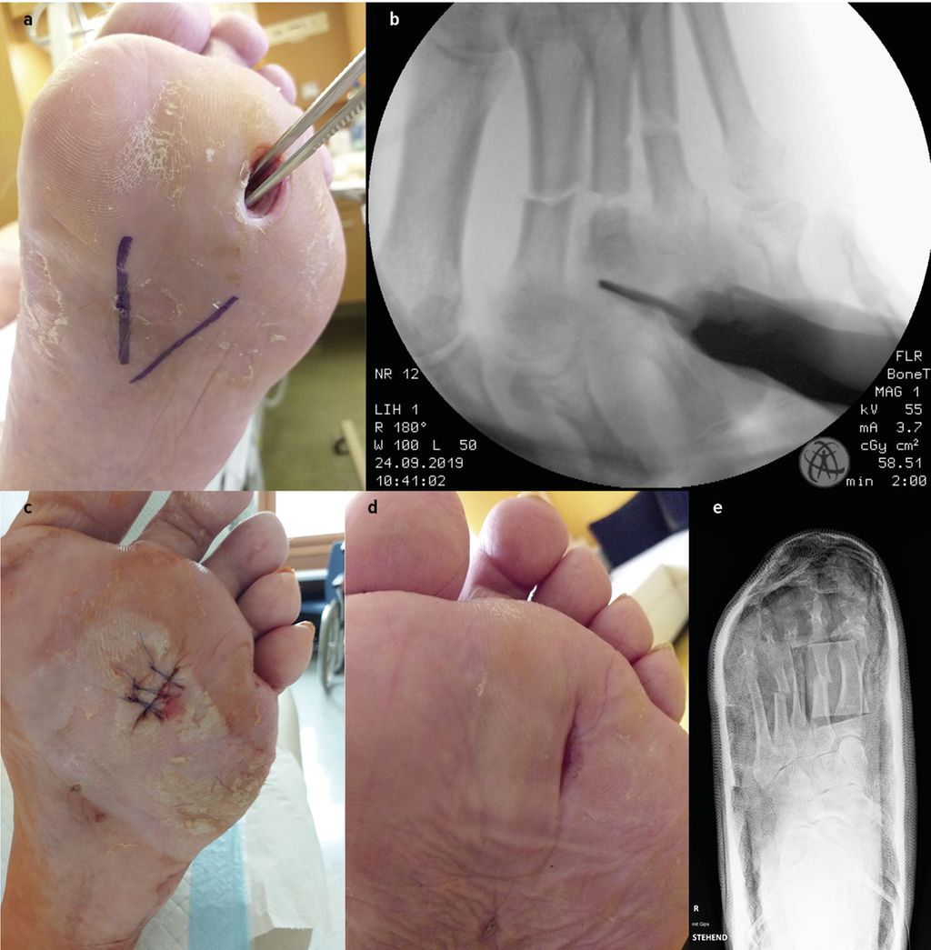 Einfache und minimalinvasive Operationen beim diabetischen Malum perfo ...
