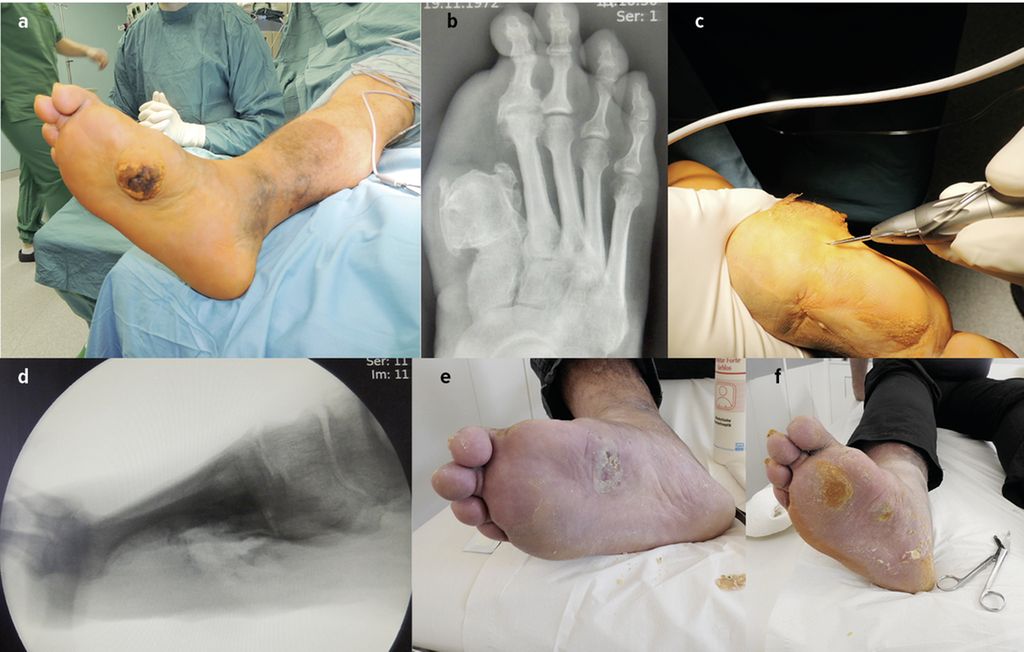 Einfache und minimalinvasive Operationen beim diabetischen Malum perfo ...