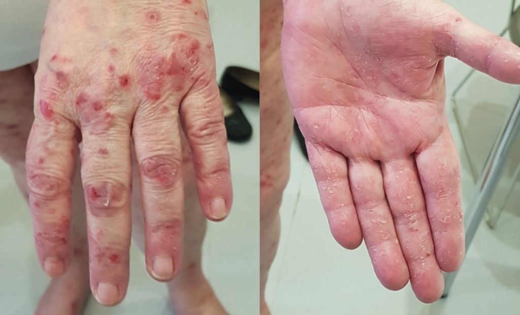 Eine Diagnose auf der anderen - Dermatologie - Universimed - Medizin im ...