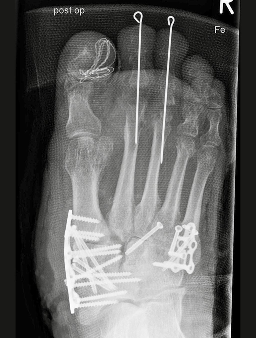 Optionen der inneren Fixation bei Charcot-Arthropathie - Orthopädie ...