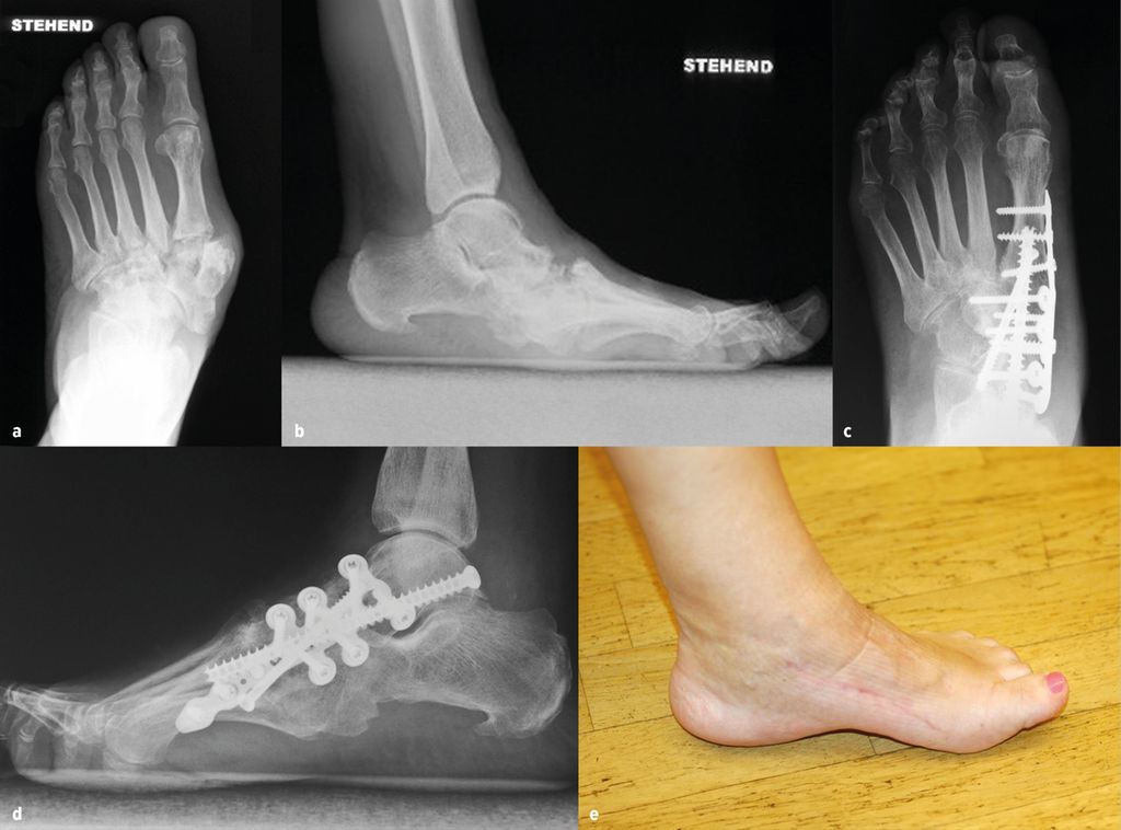 Die chirurgische Rekonstruktion des Charcot-Fußes - Orthopädie ...