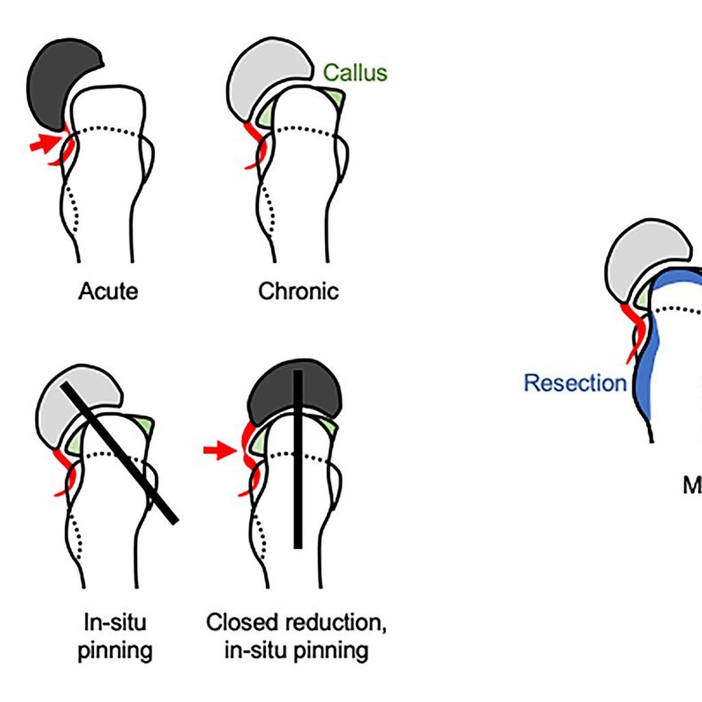Epiphysiolysis capitis femoris: Notfallversorgung - Orthopädie ...