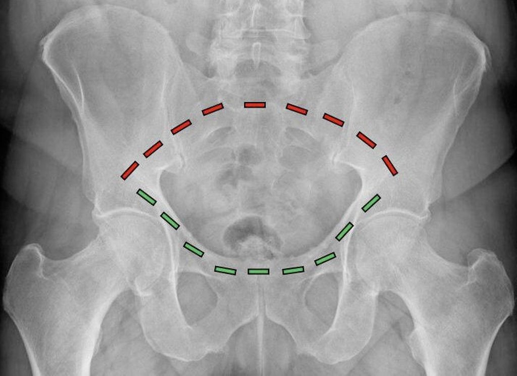 Therapie von Fragilitätsfrakturen des Beckenringes - Orthopädie ...