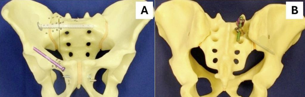 Therapie von Fragilitätsfrakturen des Beckenringes - Orthopädie ...