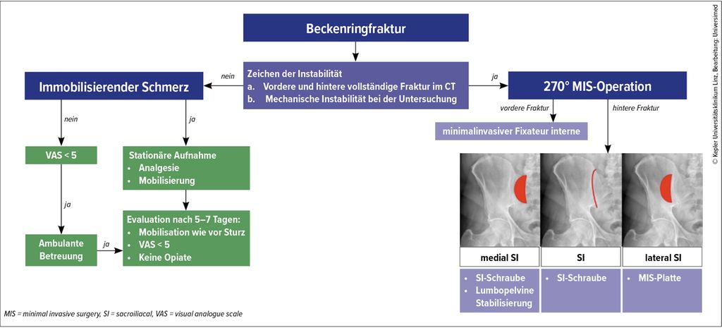 Therapie von Fragilitätsfrakturen des Beckenringes - Orthopädie ...