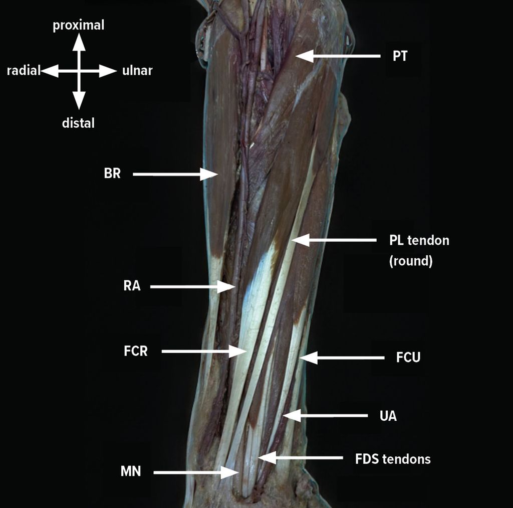 Variations in forearm tendons – A clinical-anatomical guide ...
