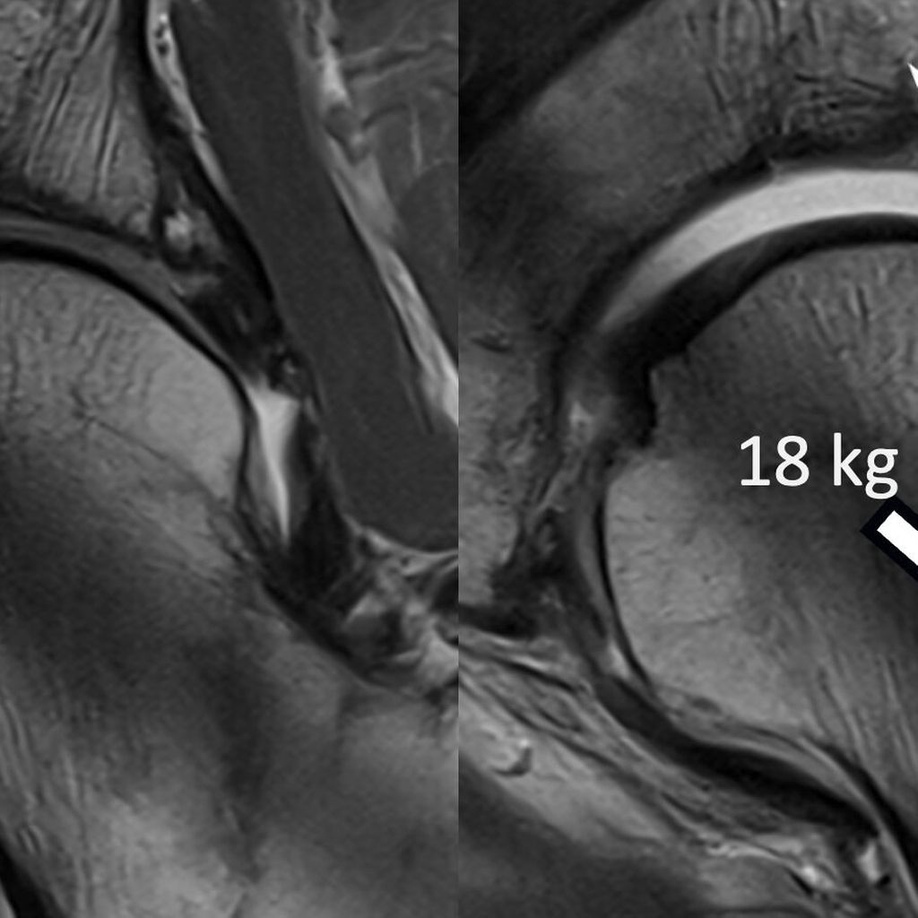 Advanced MRI techniques in hip cartilage assessment - Orthopädie ...