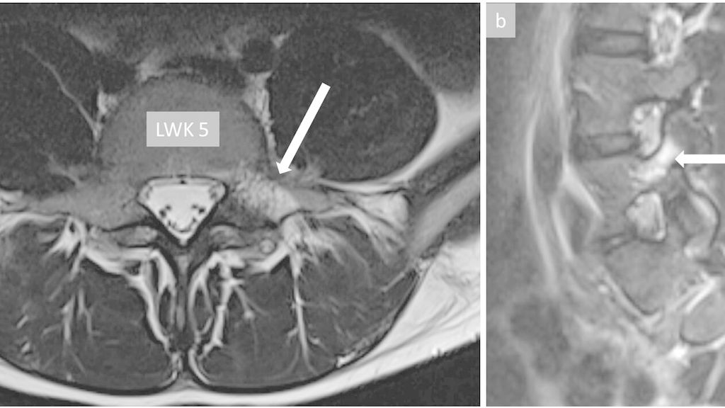 Isthmische Spondylolyse und Spondylo-listhese beKindern und ...