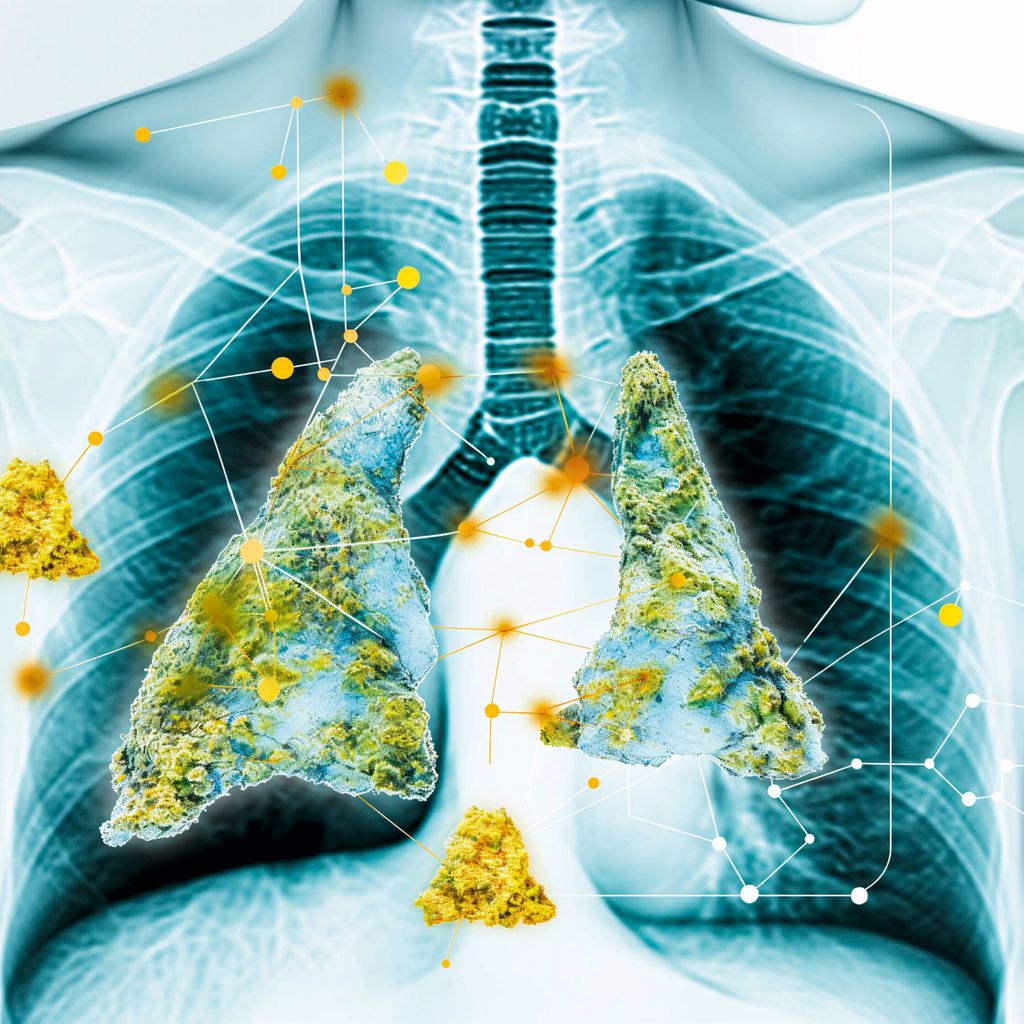 CAP mit RSV, Influenza, Covid-19 –il buono, il brutto, il cattivo ...