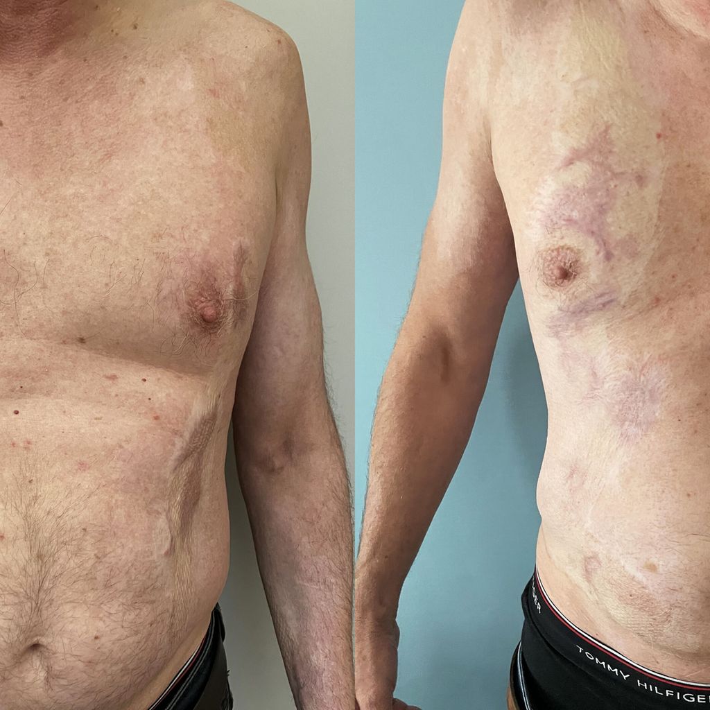 Lasertherapie von Verbrennungsnarben - Plastische Chirurgie ...