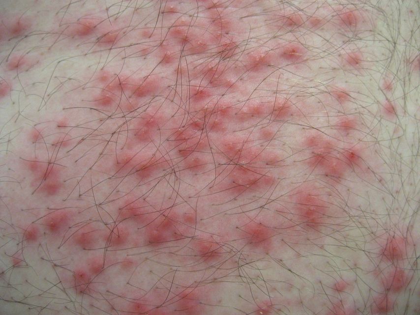 Tierbisse bei Reisenden in tropischen und subtropischen Ländern ...