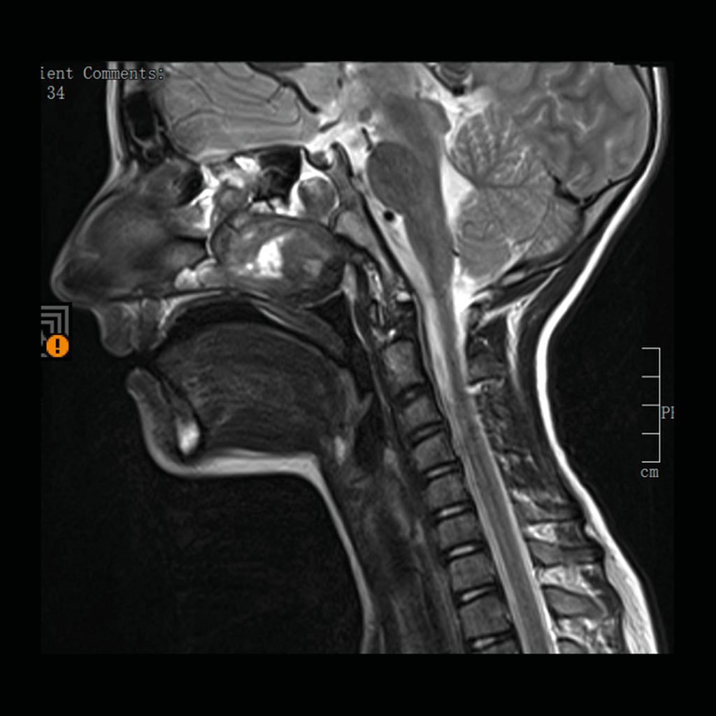 Das juvenile Angiofibrom – eine seltene Ursache von Nasenatmungsbehind ...