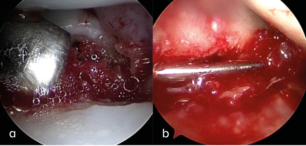 Die arthroskopische Behandlung von Kahnbeinpseudarthrosen - Orthopädie ...