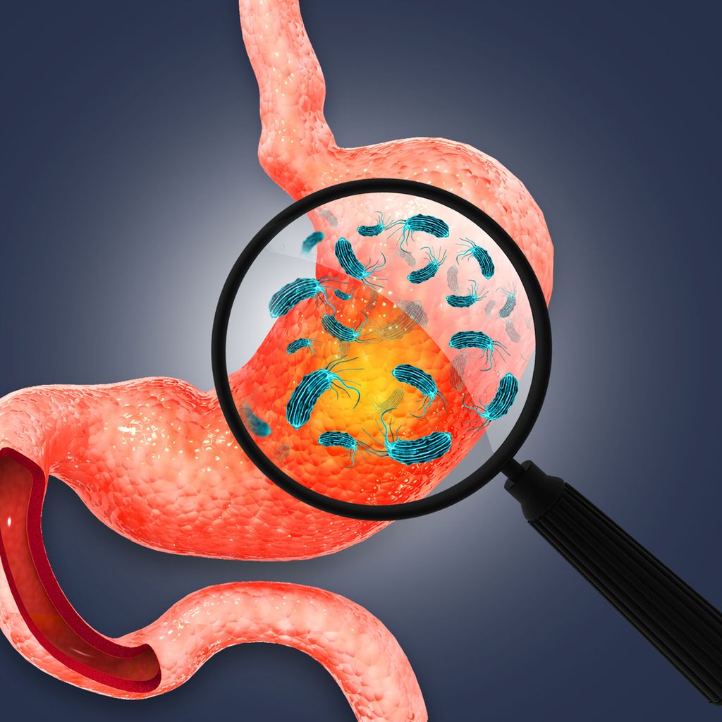 Update im therapeutischen Management der Helicobacter-pylori-Infektion ...