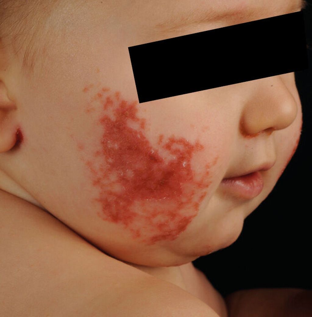 Neonatale Erythrodermie: ein potenziell lebensbedrohliches Krankheitsb ...