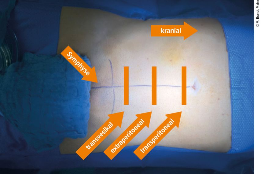 Erste Erfahrungen mit Da Vinci single port – was ist der wirkliche Vor ...