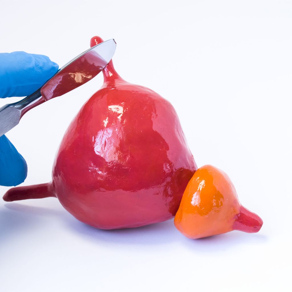 Zytoreduktive Prostatektomie und Metastasektomie beim metastasierten P ...