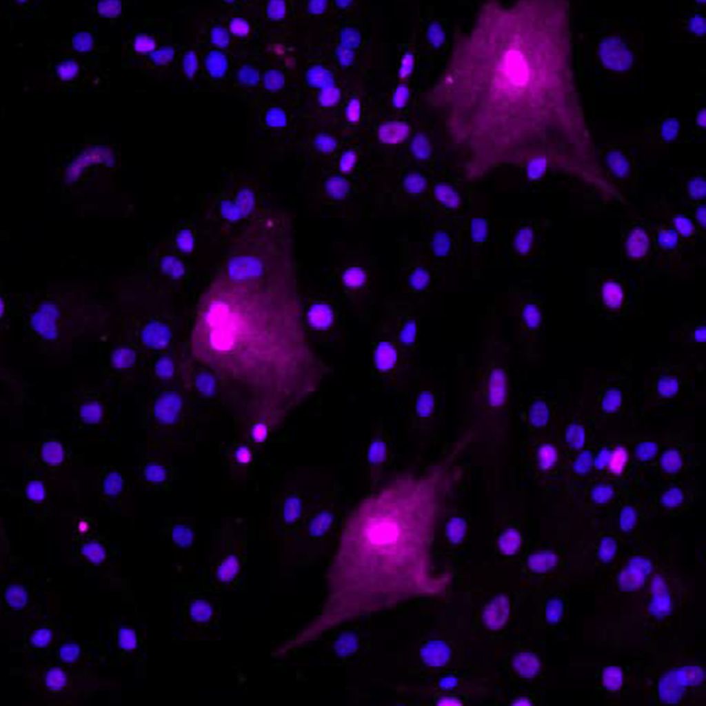 Neue Therapieansätze für Arthrose - Universimed - Knowledge that matters