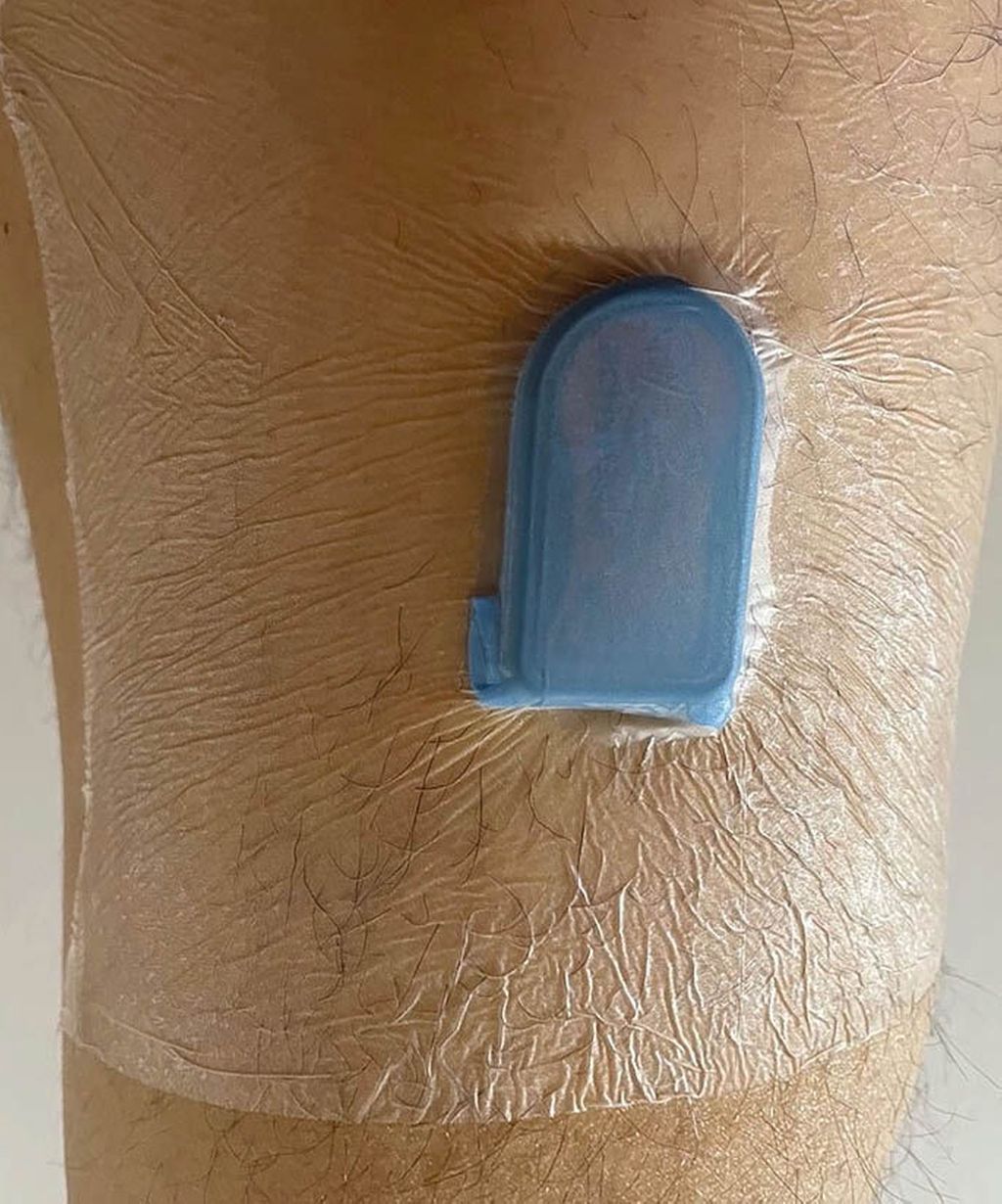 Mobilitätsmessungen bei Patienten mit Schenkelhalsfrakturen ...