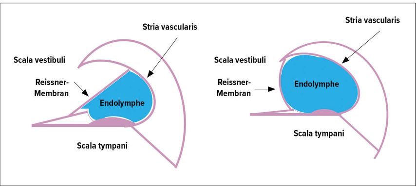 Morbus Menière: Klinik, Pathophysiologie und neue klinische Guidelines ...