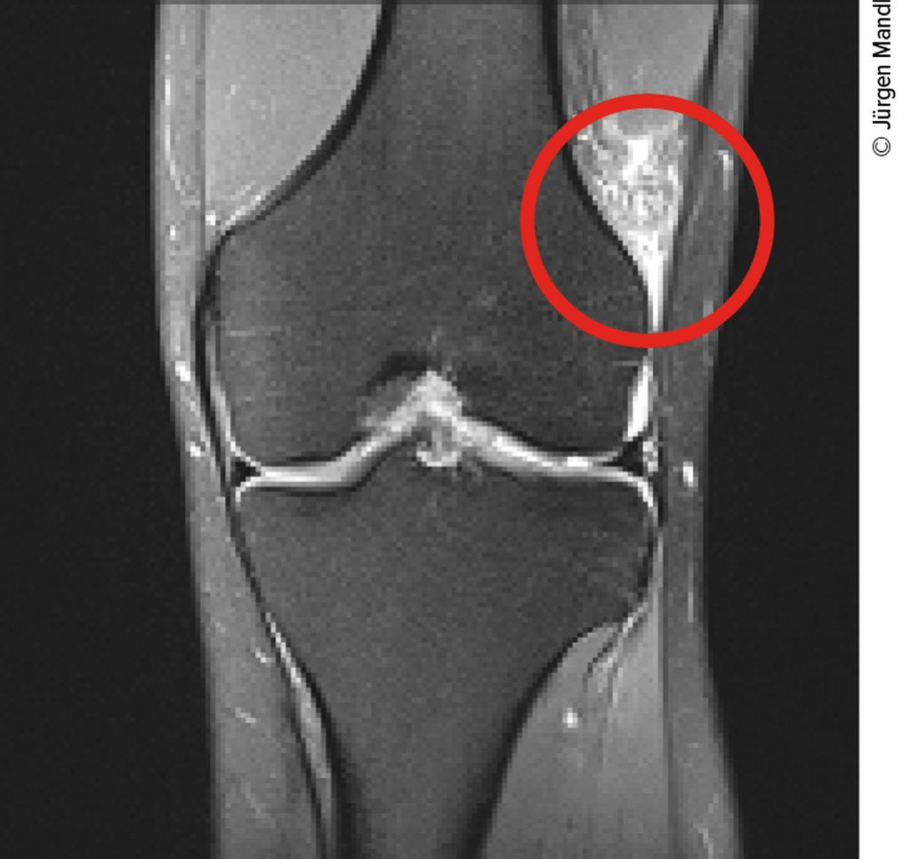 Das anterolaterale Eck des Kniegelenkes - Orthopädie & Traumatologie ...